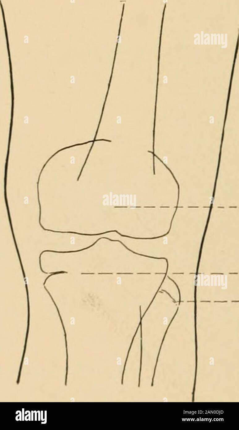 The treatment of fractures . Fig. 435.—Same case as figure 434 ...
