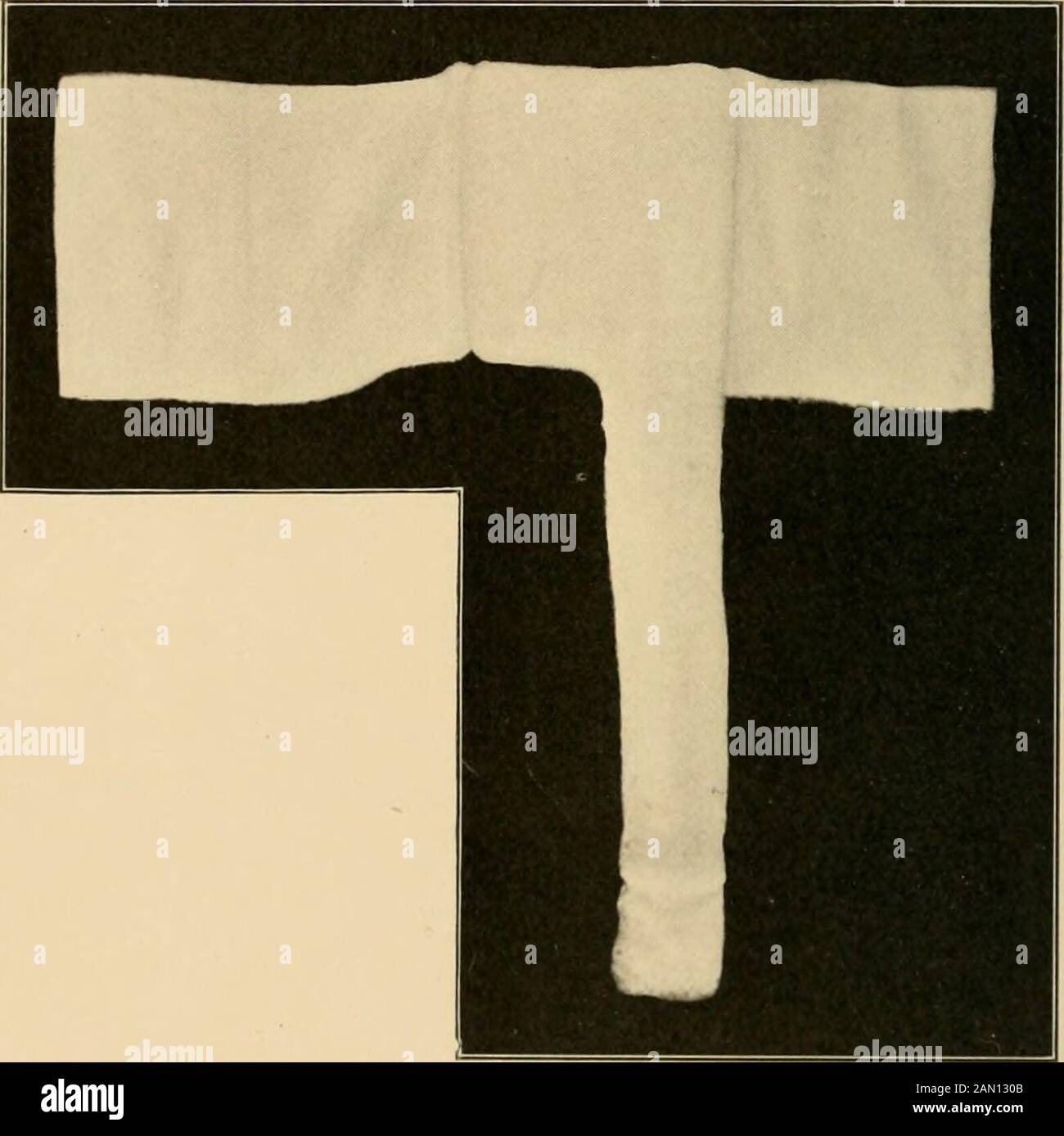 The treatment of fractures . Fig. 426.—The Cabot wire splint ready for ...