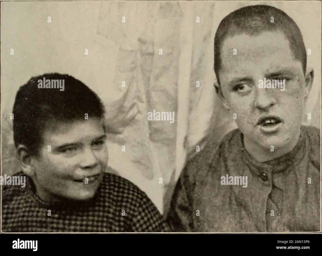 Microcephaly Pinhead