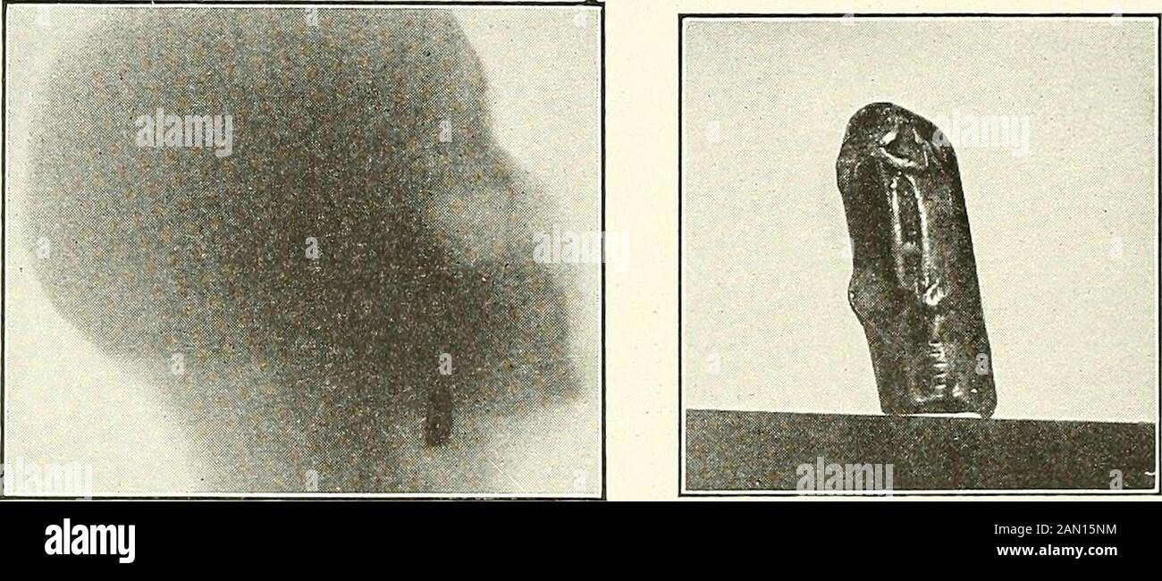 Gunshot injuries : how they are inflicted : their complications and ...