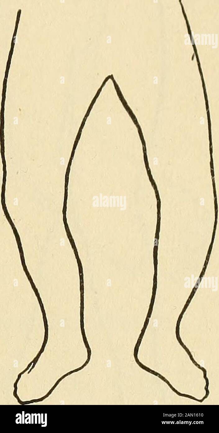 Rickets disease legs hi-res stock photography and images - Alamy