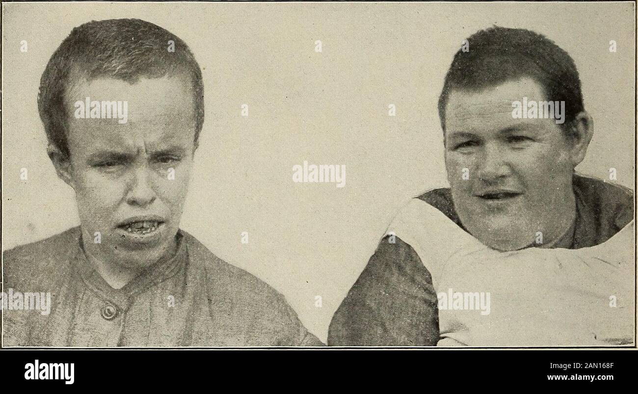 Nervous and mental diseases . Fig. 317.—Cretiu aged thirteeu years ...