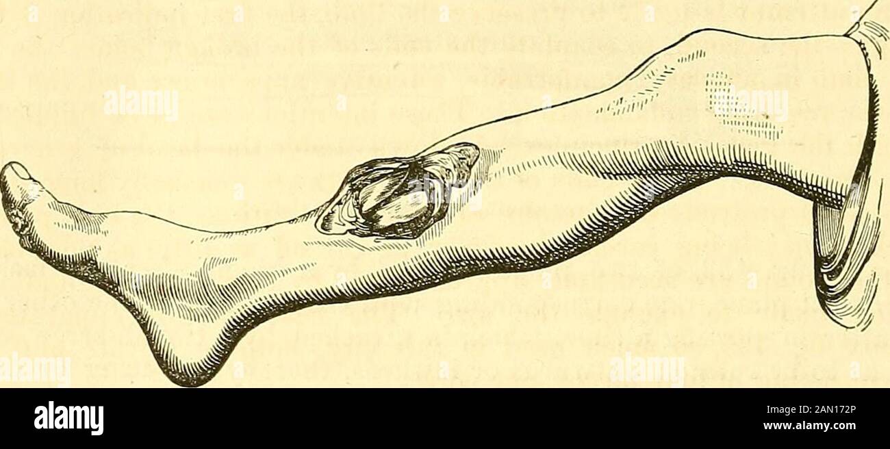 A system of surgery : pathological, diagnostic, therapeutic, and ...