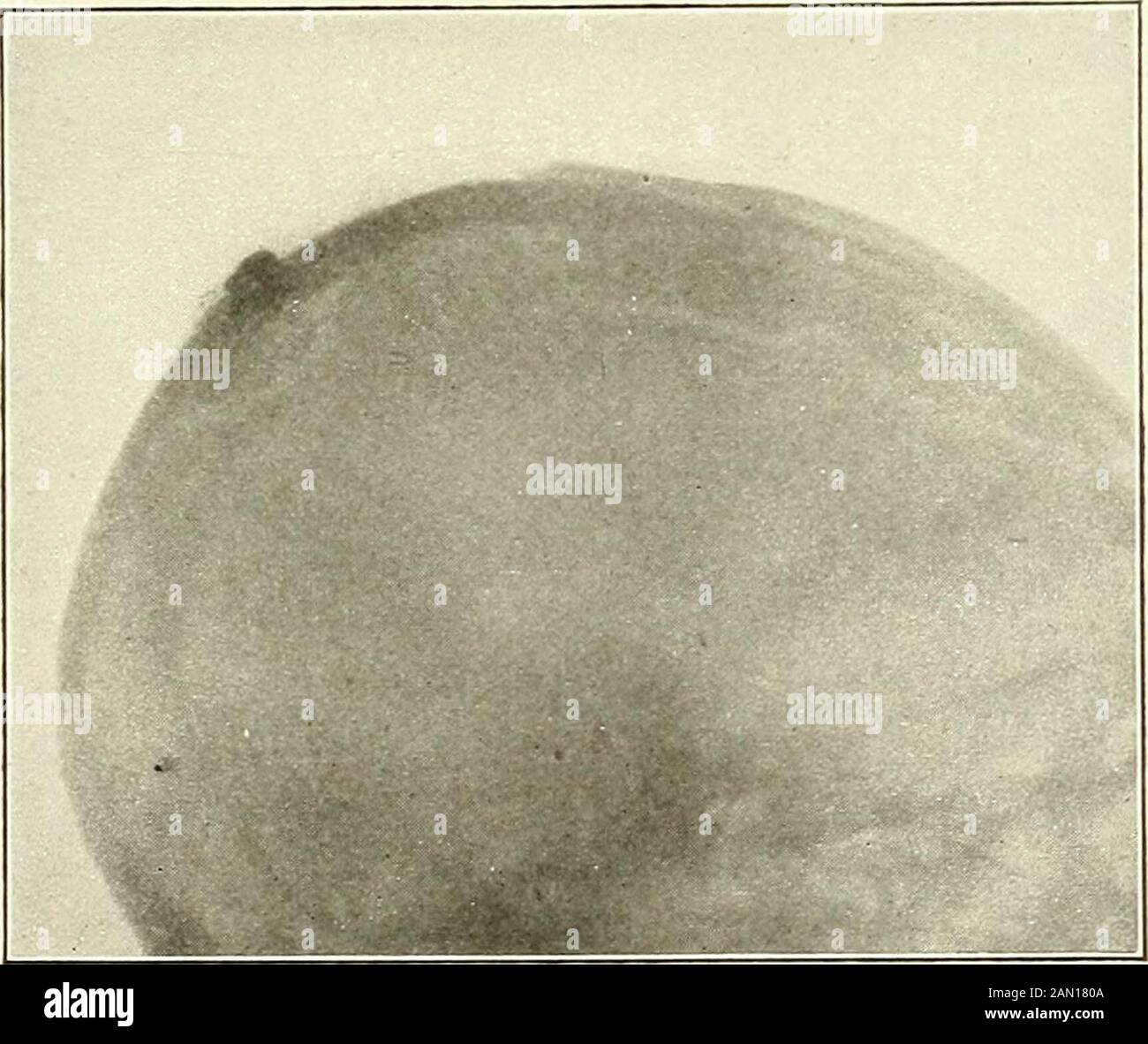 Gunshot Bullet Wound Stock Photos & Gunshot Bullet Wound Stock Images ...