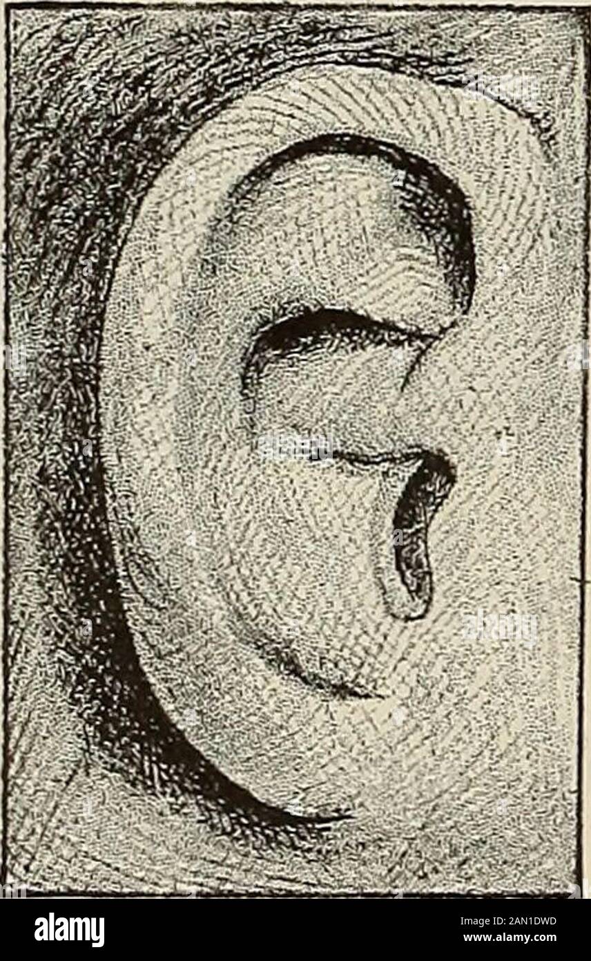 Nervous and mental diseases . Fig. 298.—^No crus superius;no anthelix ...