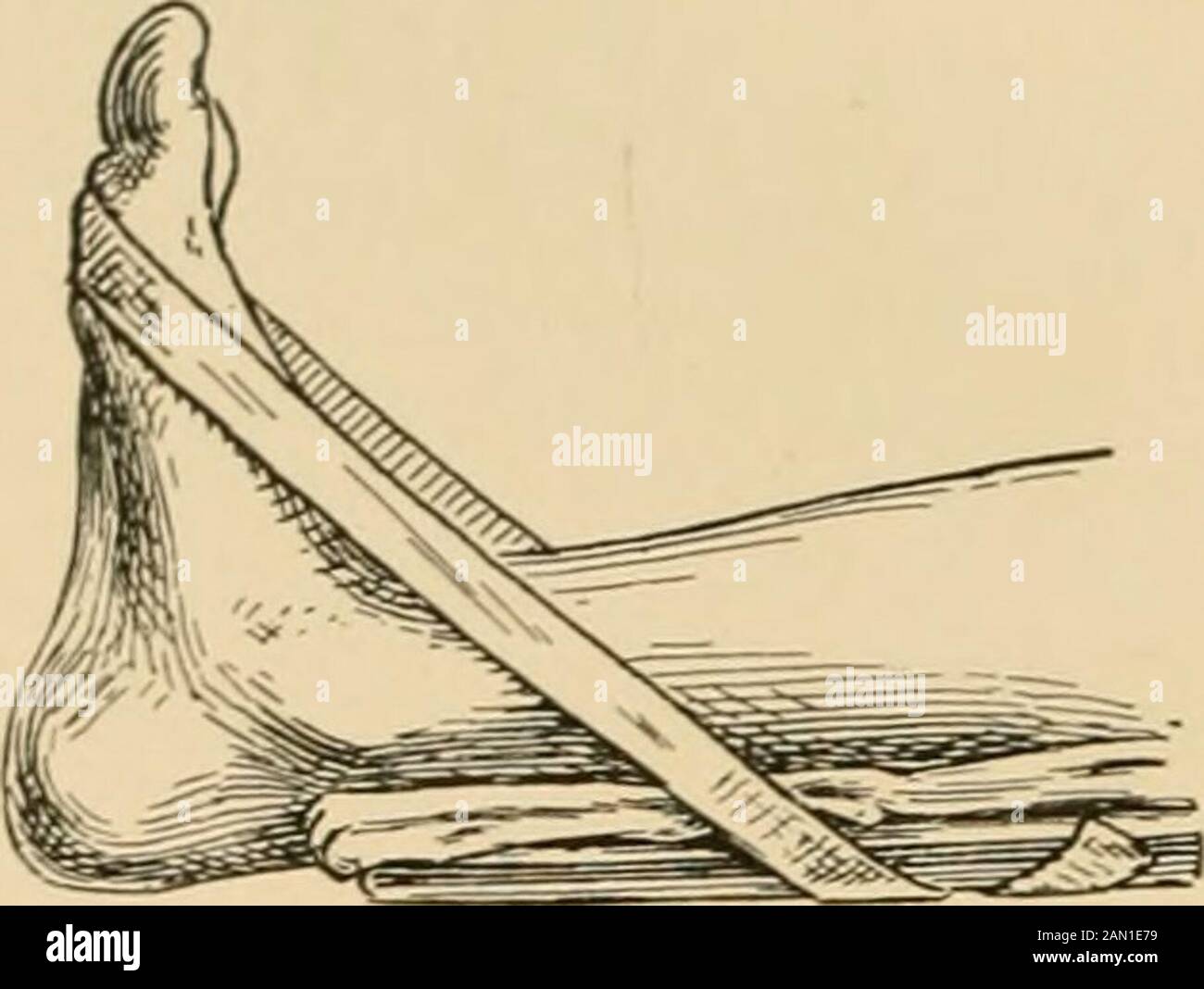 The treatment of fractures . Fig. 399.—Fracture of the thigh. Completed ...