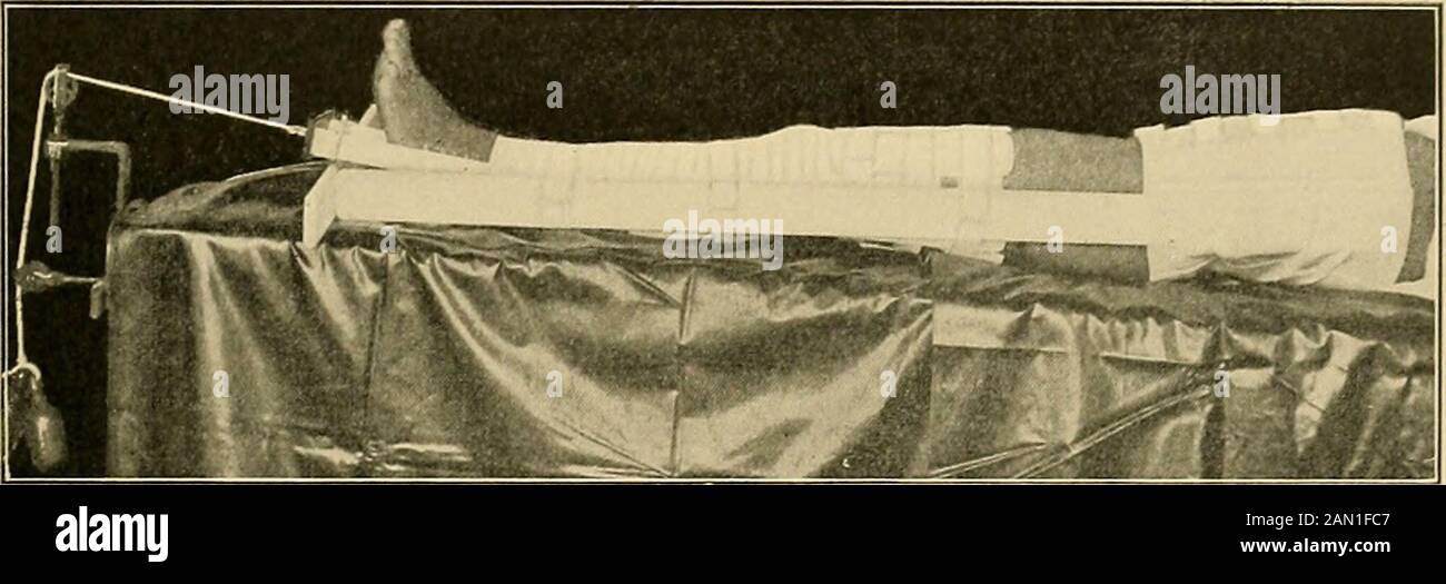 Leg fracture traction hi-res stock photography and images - Alamy