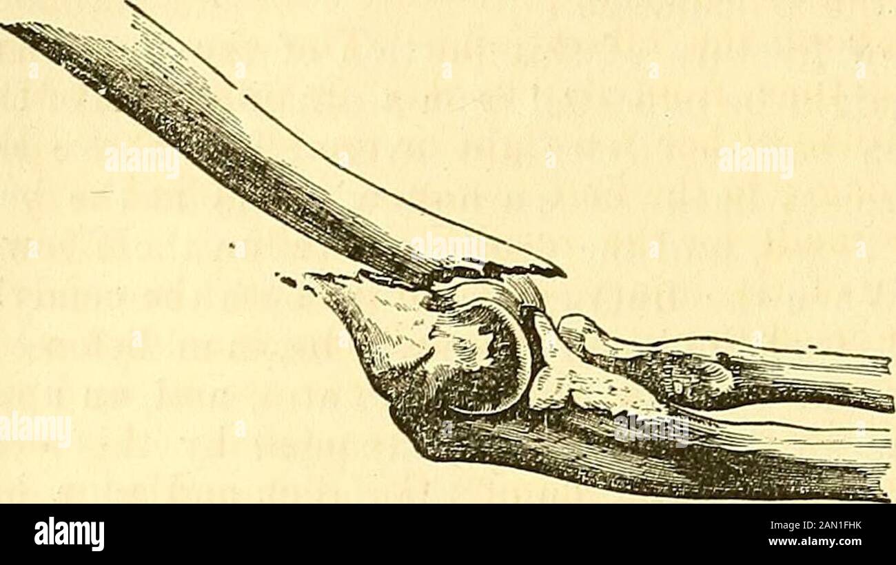Pathological fractures hi-res stock photography and images - Alamy