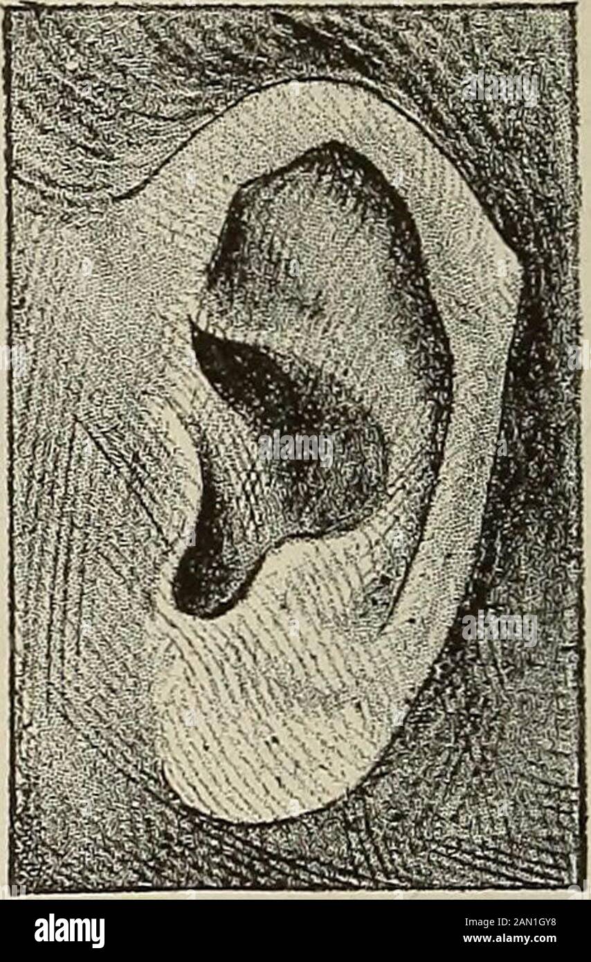 Nervous and mental diseases . Fig. 291.—stahl ear, No. 1. Fig. 292 ...