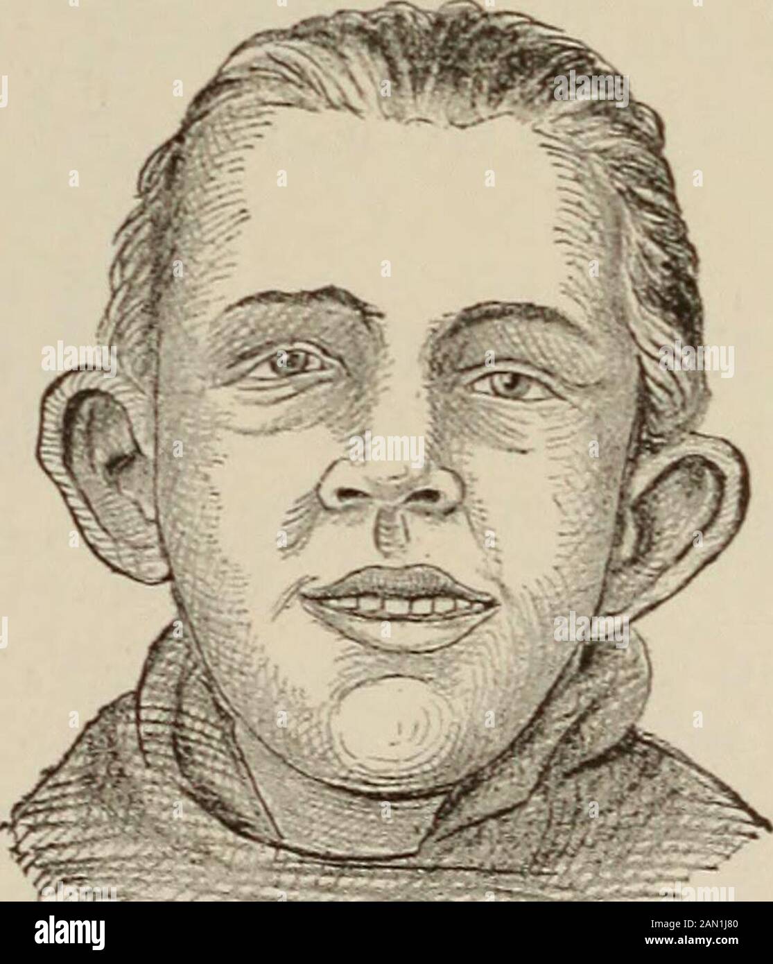 Nervous and mental diseases . Fig. 289.—Blainville ear : also excessive ...