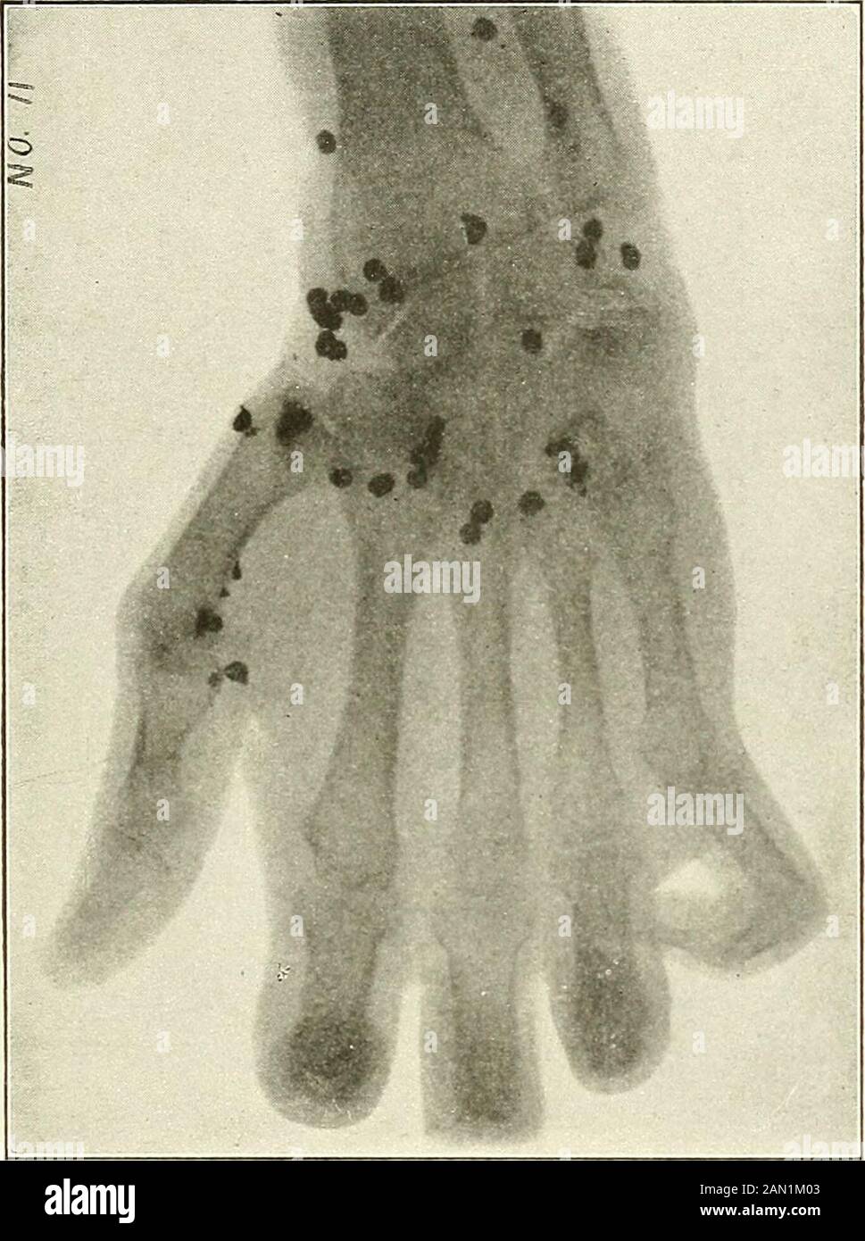 Gunshot injuries : how they are inflicted : their complications and ...