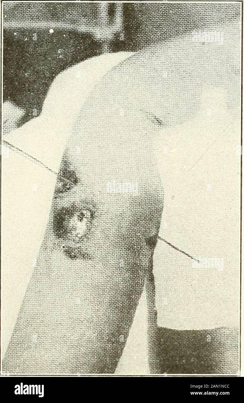 Shrapnel wounds hi-res stock photography and images - Alamy