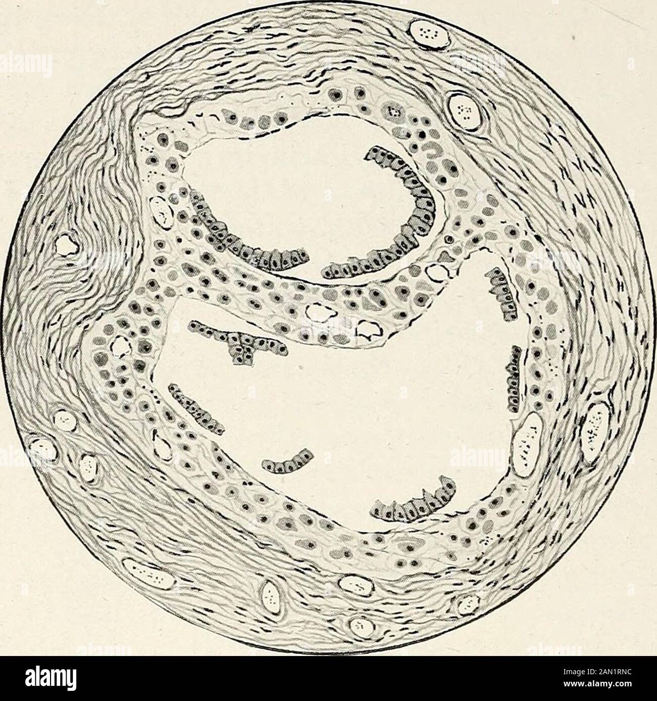 Large ovarian cyst hi-res stock photography and images - Alamy