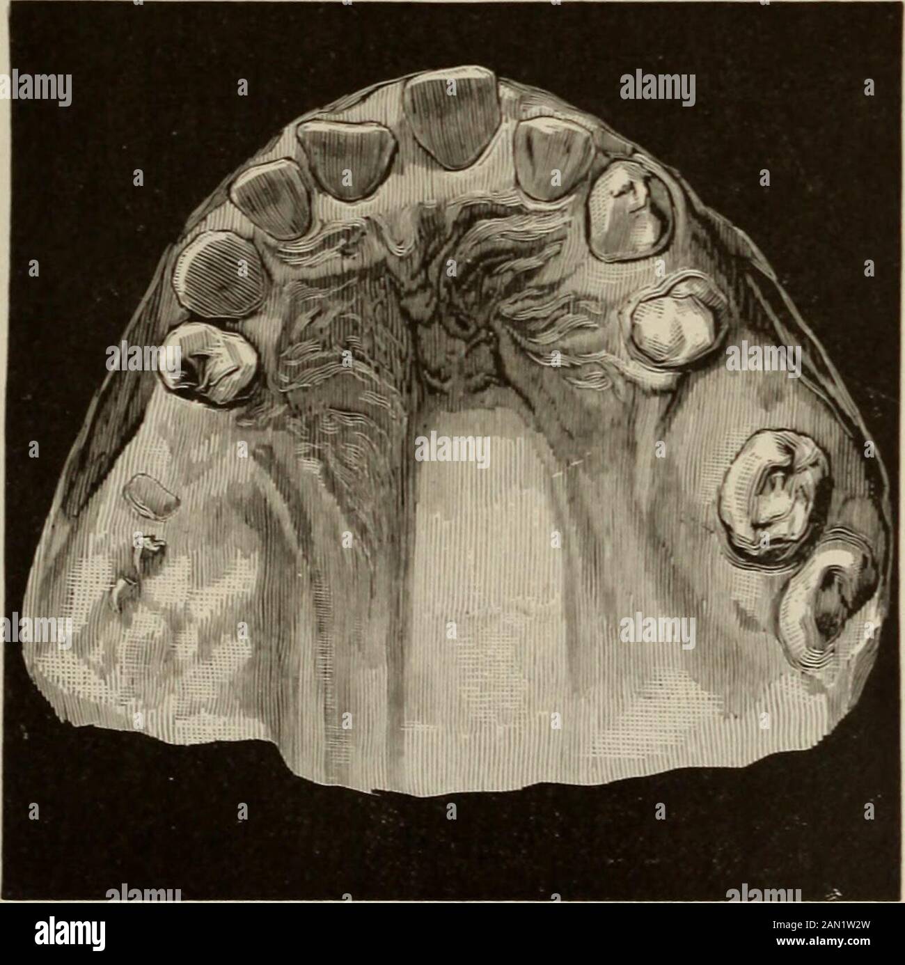 Nervous and mental diseases . Fig. 283.—The dome-shaped palate.. Fig ...
