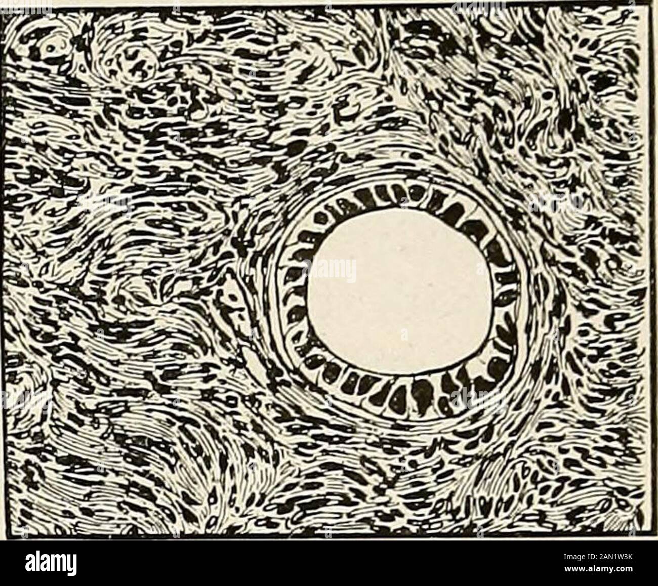 Ovary simple cyst hi-res stock photography and images - Alamy