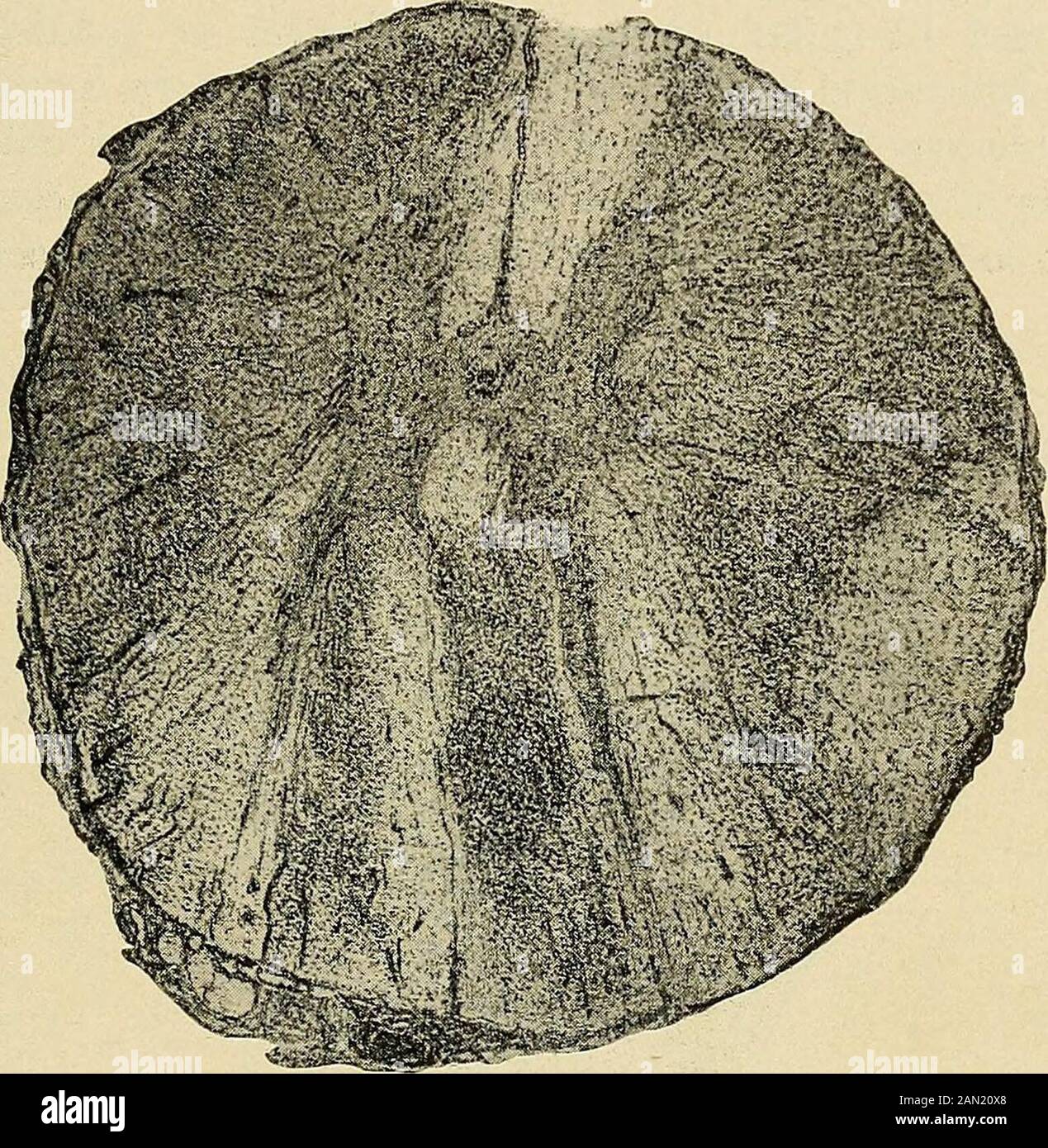 Endarteritis hi-res stock photography and images - Alamy