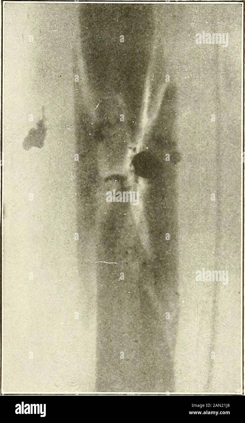 Gunshot injuries : how they are inflicted : their complications and ...