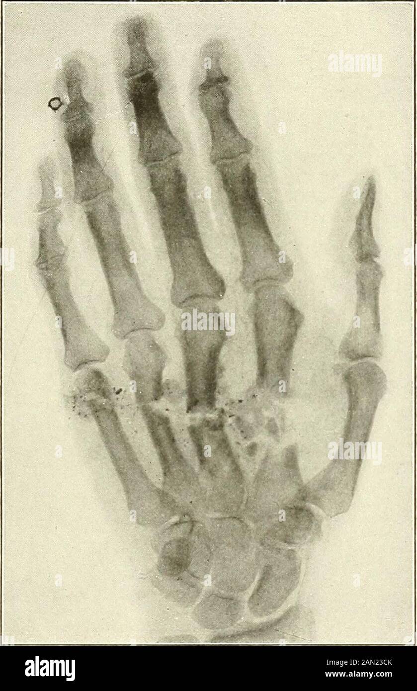 Gunshot injuries : how they are inflicted : their complications and ...