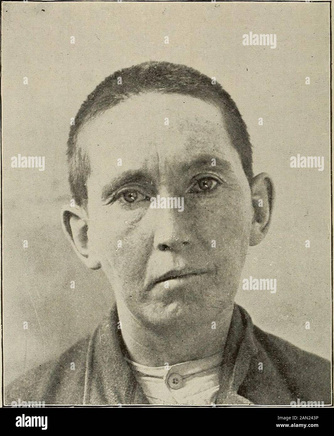 Various deformities hi-res stock photography and images - Alamy