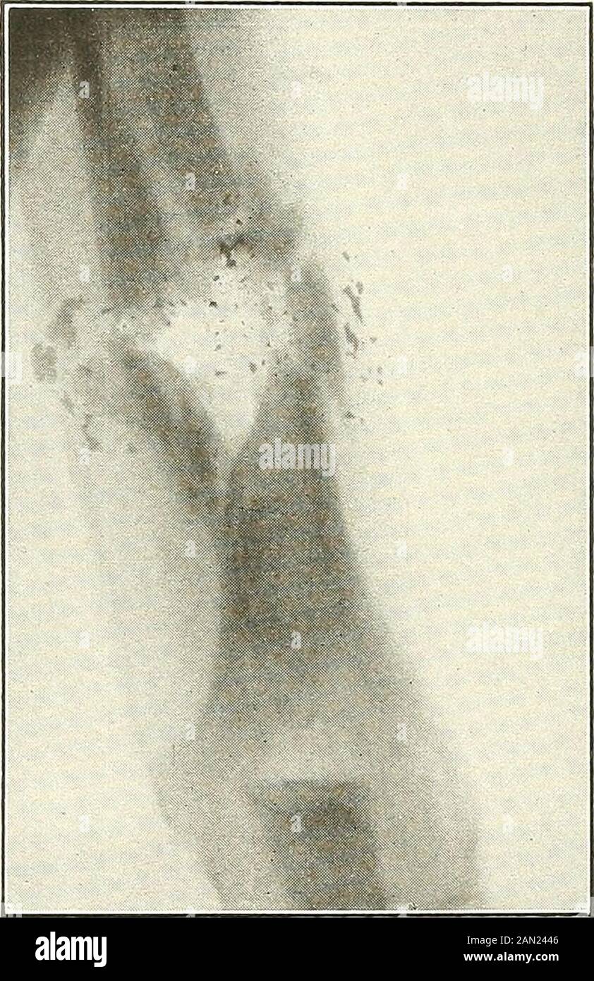 Gunshot injuries : how they are inflicted : their complications and ...