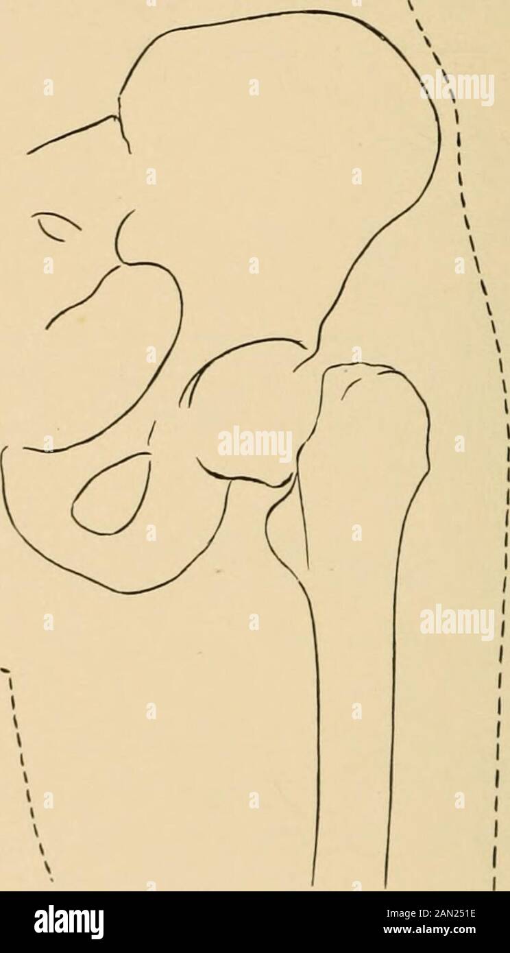 The treatment of fractures . t.Useful limb (X-ray tracing). thigh even ...
