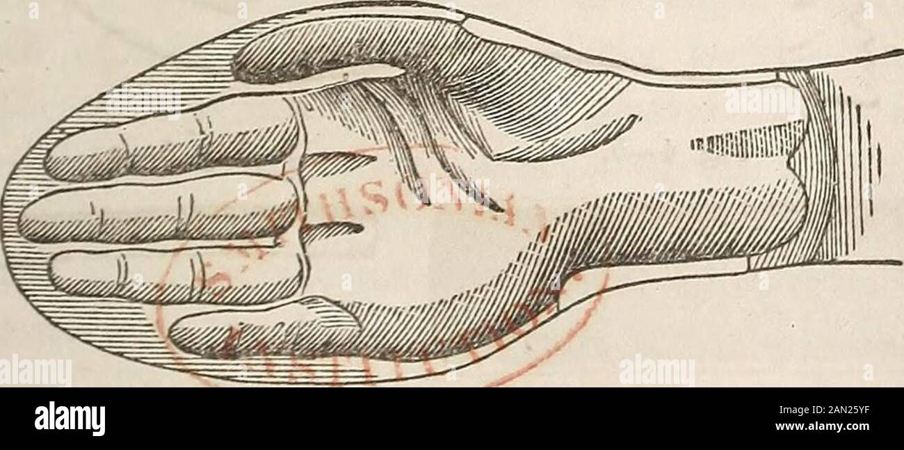 Colles fracture hi-res stock photography and images - Alamy