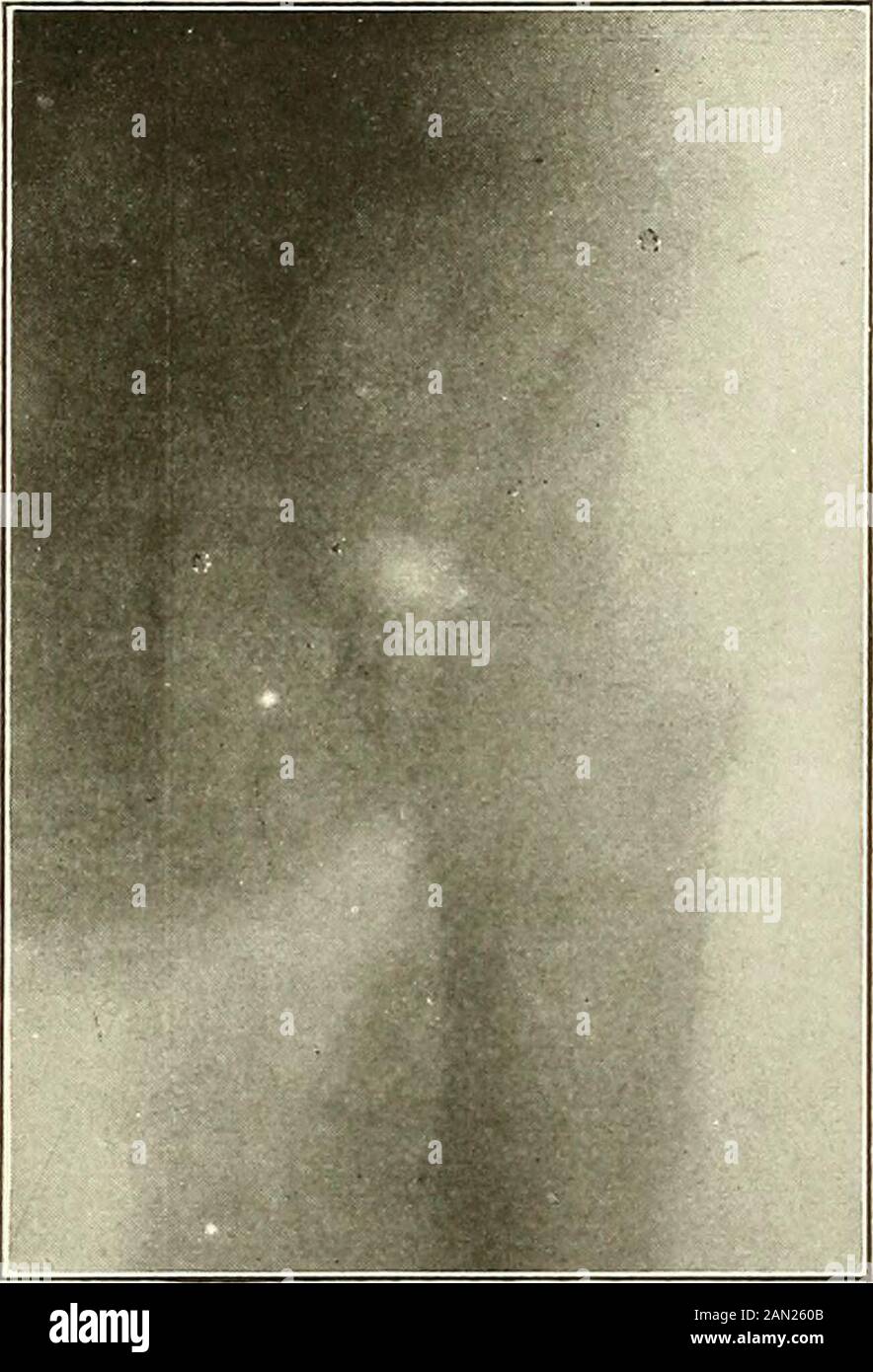 Gunshot injuries : how they are inflicted : their complications and ...