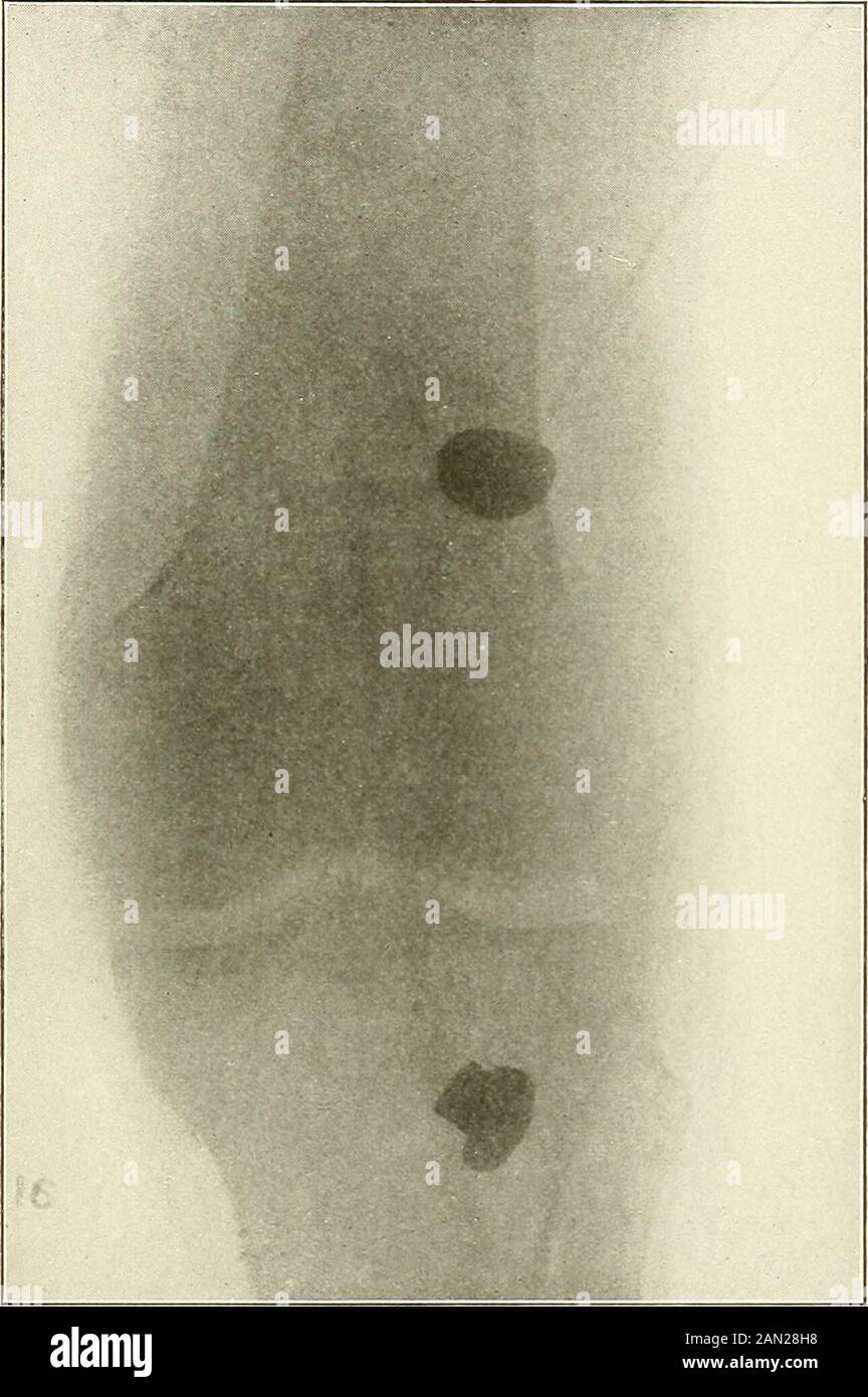 Gunshot injuries : how they are inflicted : their complications and ...