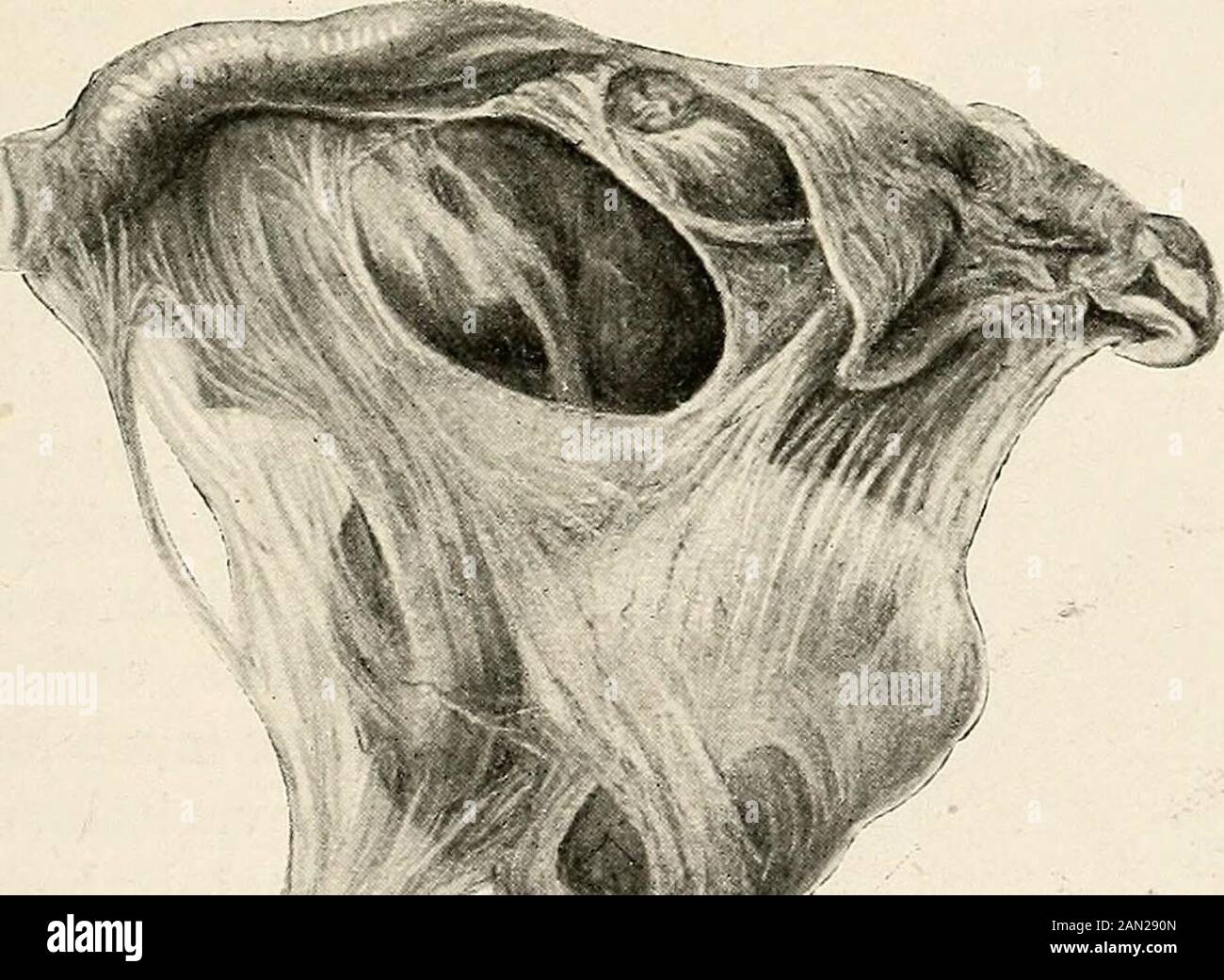 Gynaecology for students and practitioners . Fig. 340. Chronic Salpingo ...