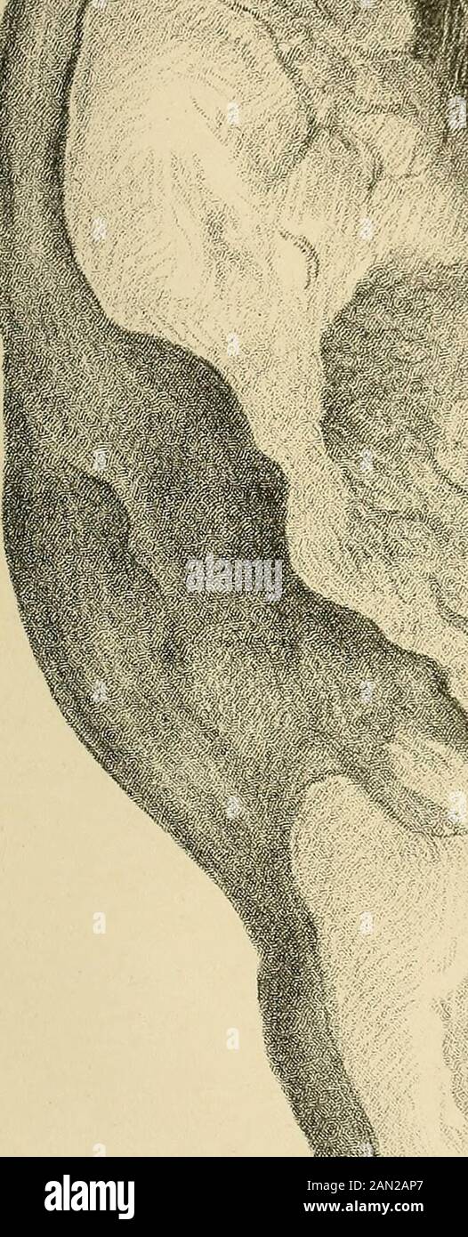 Clinical lectures on stricture of the urethra and other disorders of ...