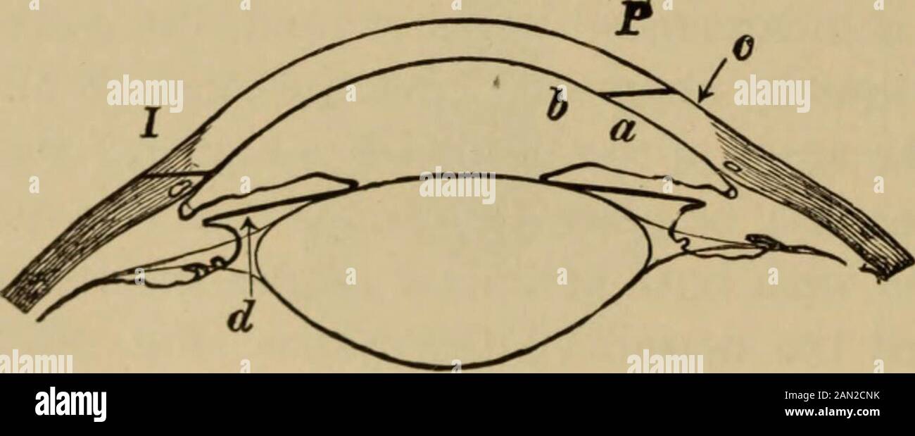 Paracentesis Eye