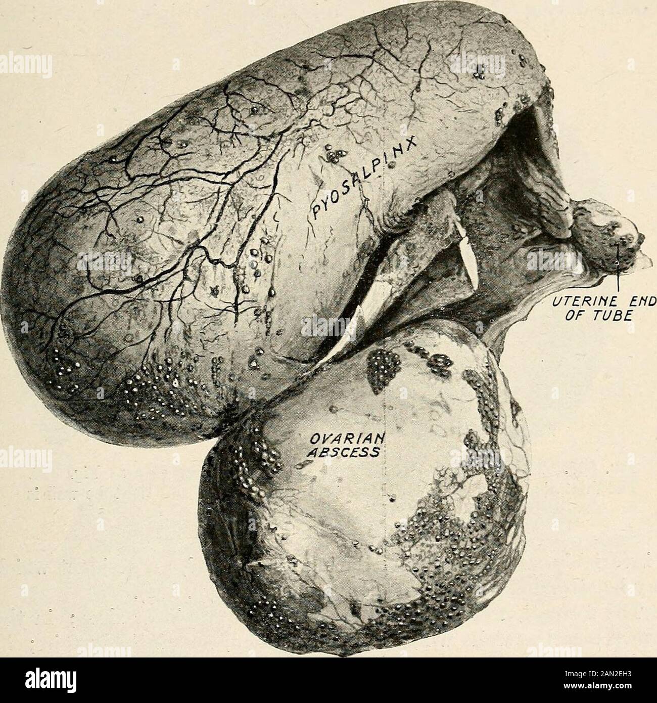 Gynaecology for students and practitioners . INFLAMMATION OF THE ...
