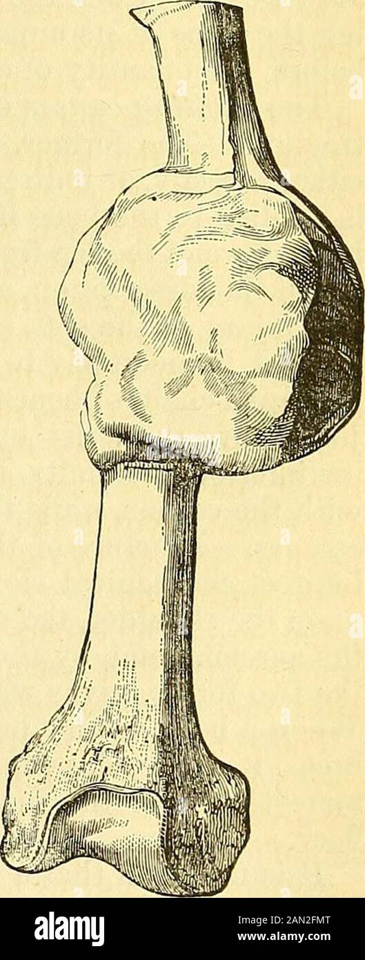 Skeleton rickets hi-res stock photography and images - Alamy