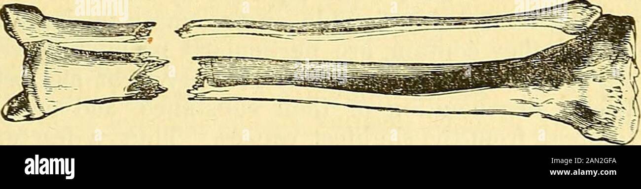 Impacted fracture hi-res stock photography and images - Alamy