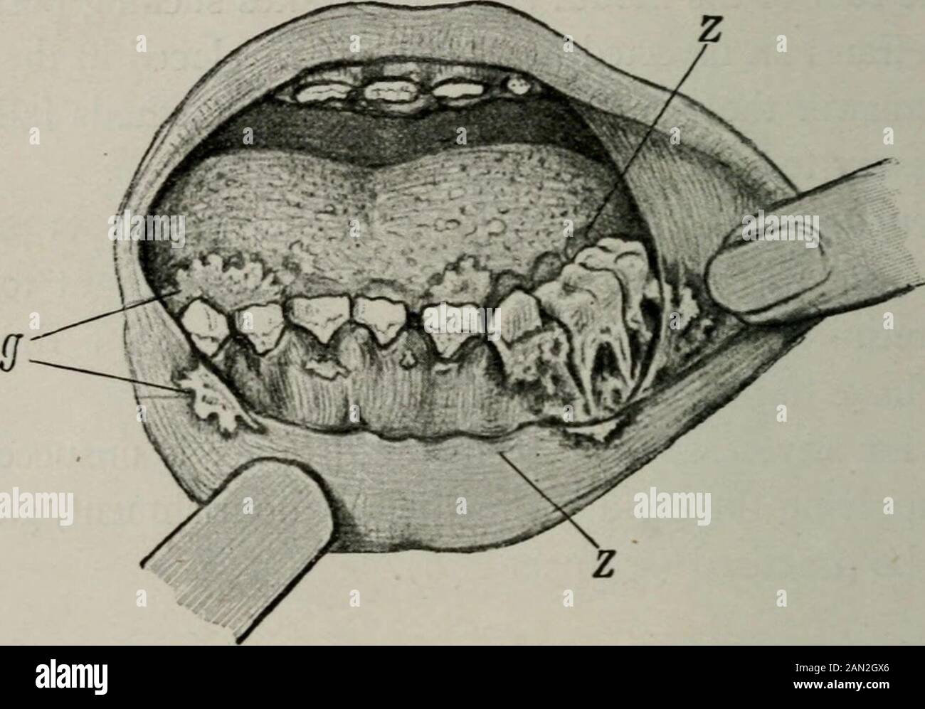 Glossitis hi-res stock photography and images - Alamy
