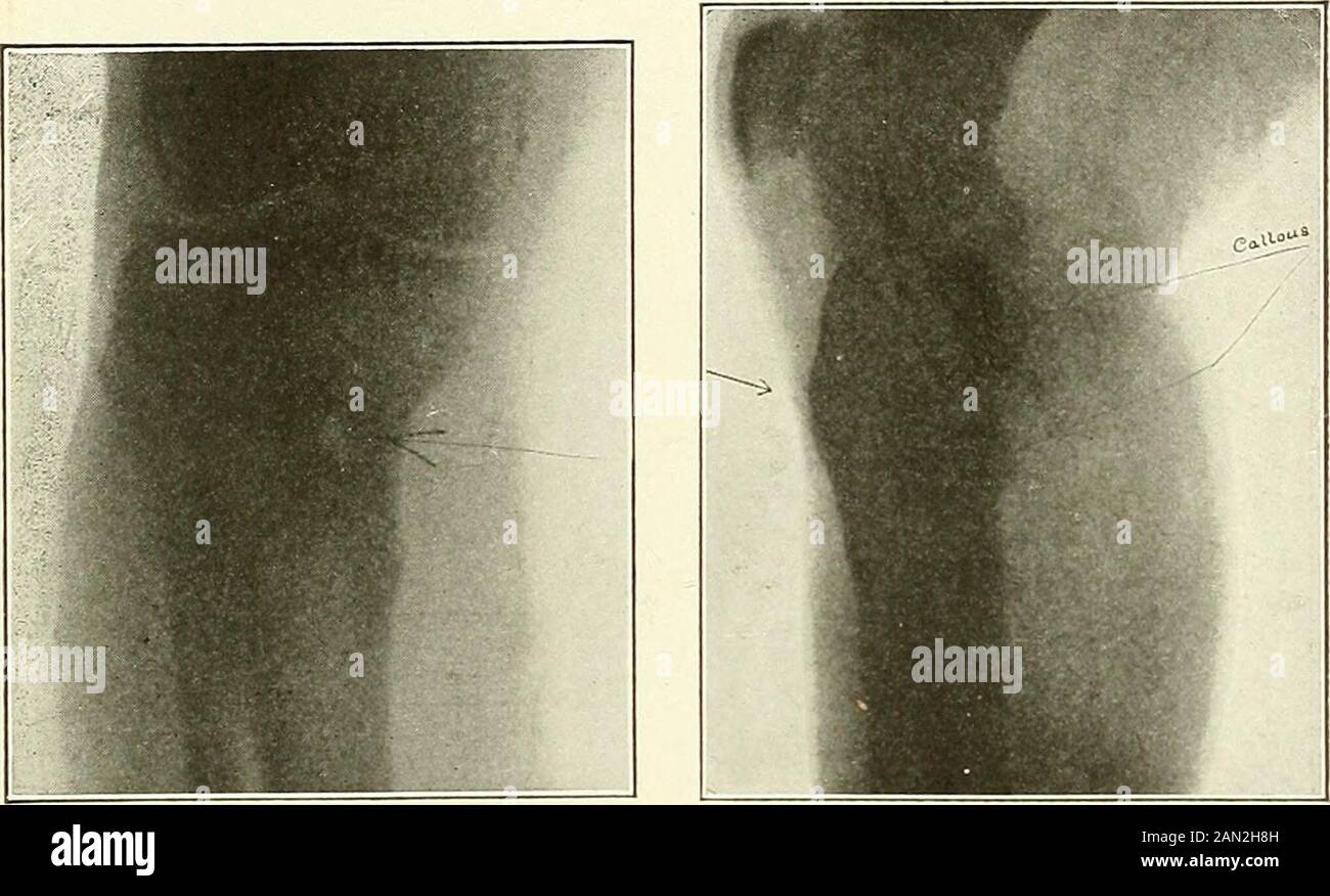Gunshot injuries : how they are inflicted : their complications and ...