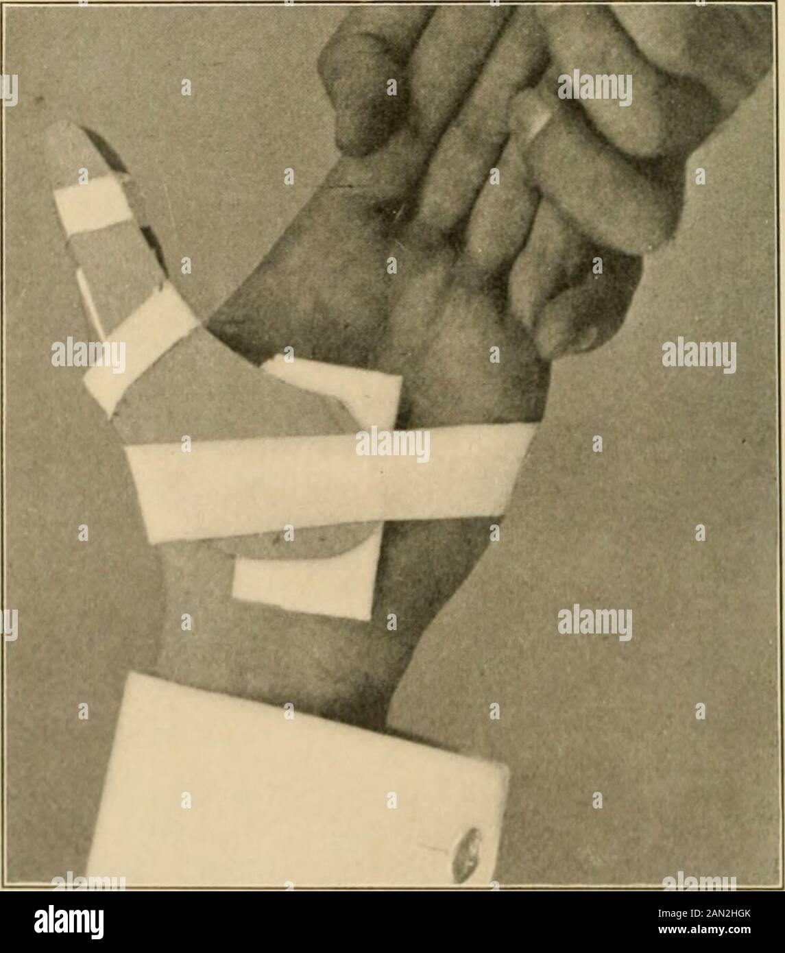 Metacarpal base fracture hi-res stock photography and images - Alamy