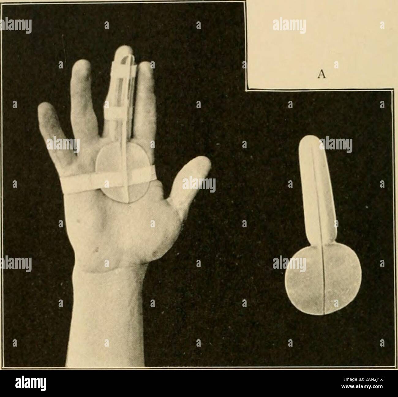 The treatment of fractures . Fig. 343- — Fracture of the finger.Wooden ...