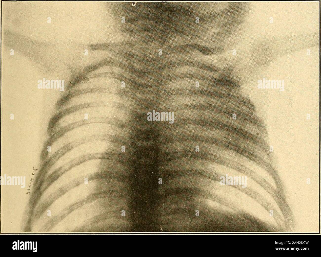 Lung nodules hi-res stock photography and images - Alamy