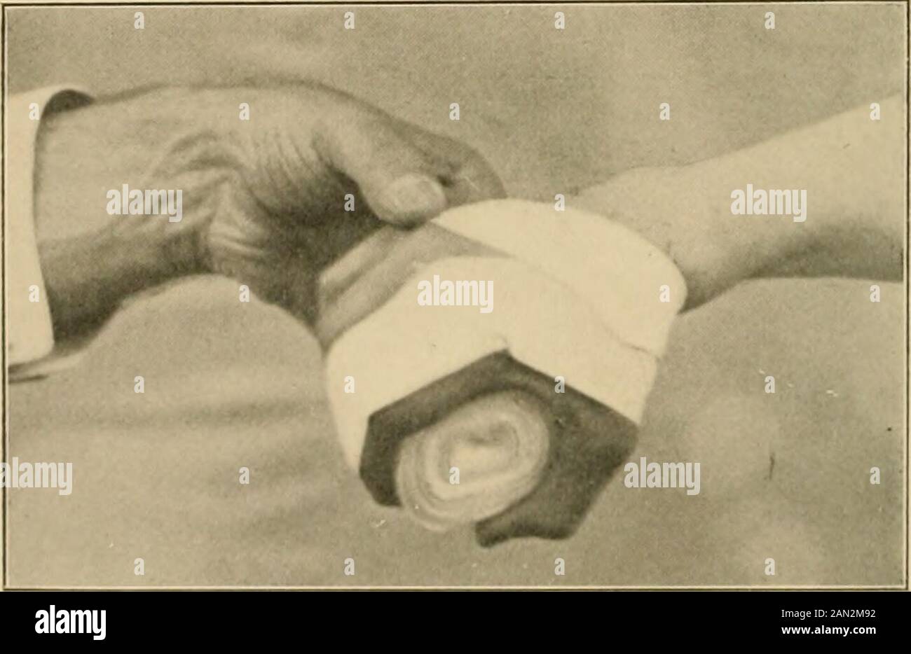 The treatment of fractures . Fig. 336-—Fracture of the metacarpal of ...
