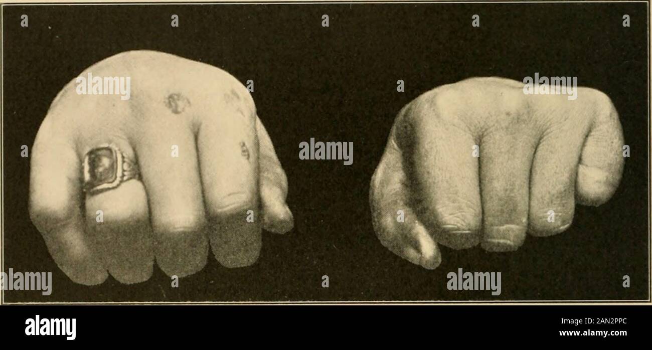 Third metacarpal fracture hi-res stock photography and images - Alamy