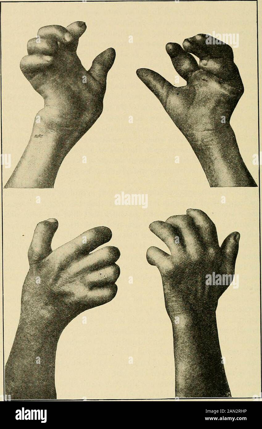 Bullae skin hi-res stock photography and images - Alamy