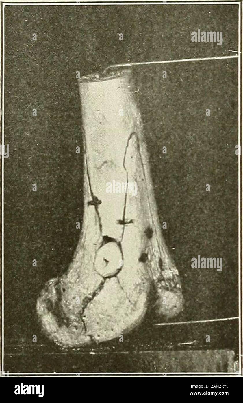 Gunshot injuries : how they are inflicted : their complications and ...