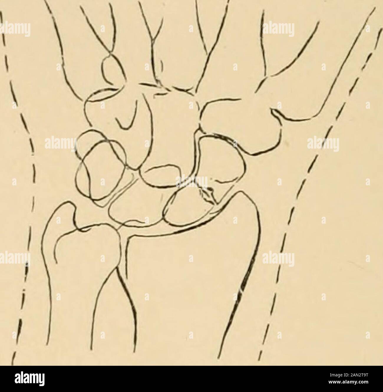 The treatment of fractures . Scaphoid fragment.Scaphoid fragment ...