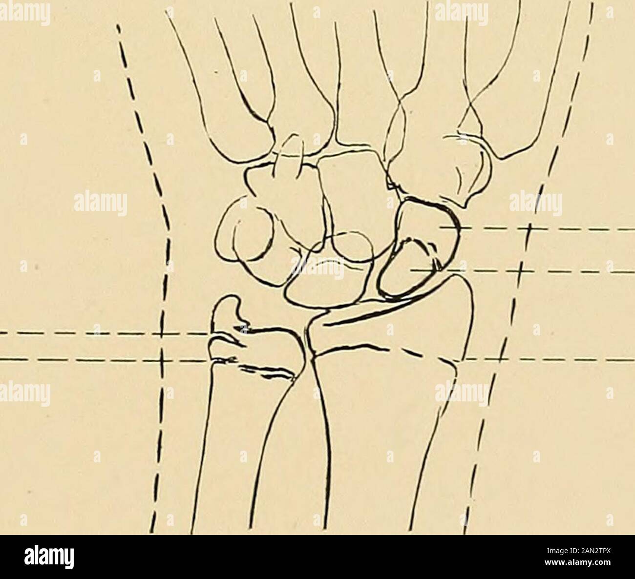 The treatment of fractures . Scaphoid fragment. Scaphoid fragment ...