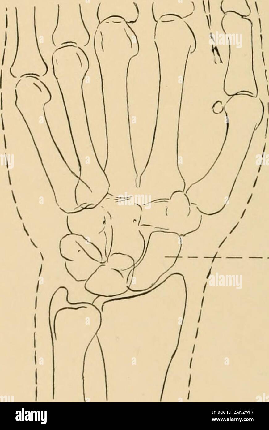 Colles Fracture Splint