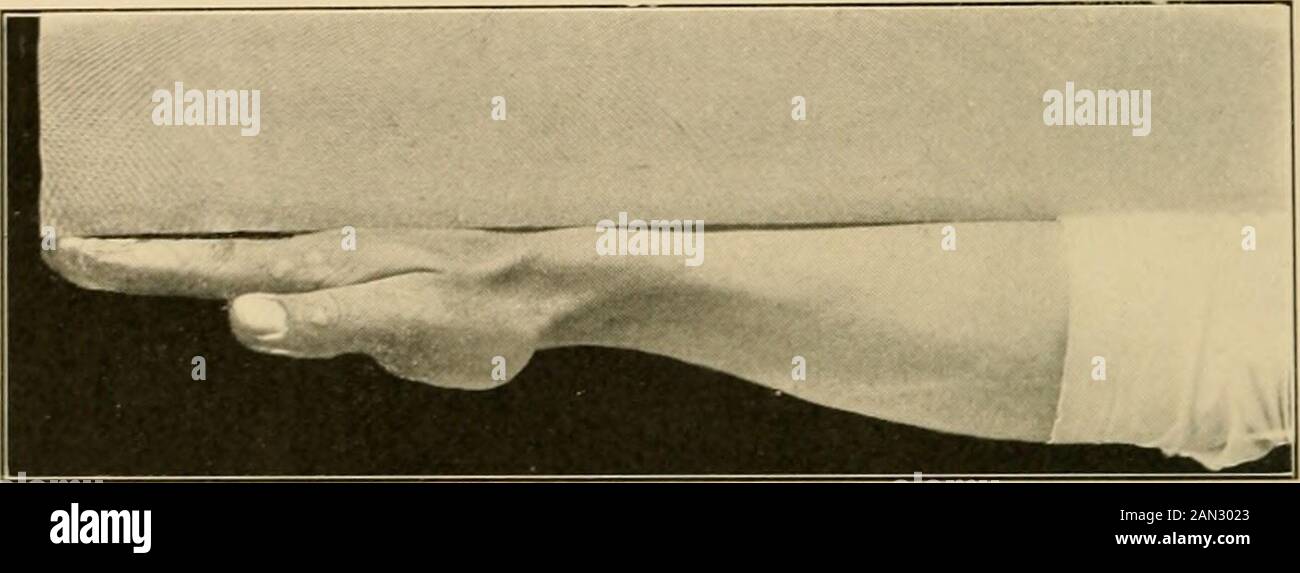 The treatment of fractures . ather muscular and large arm, it is best ...