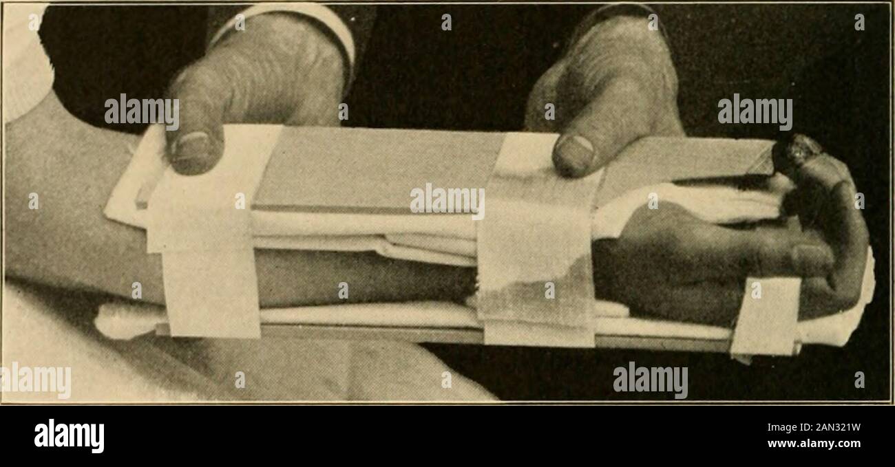 The treatment of fractures . t and pad andof holding the two splints ...