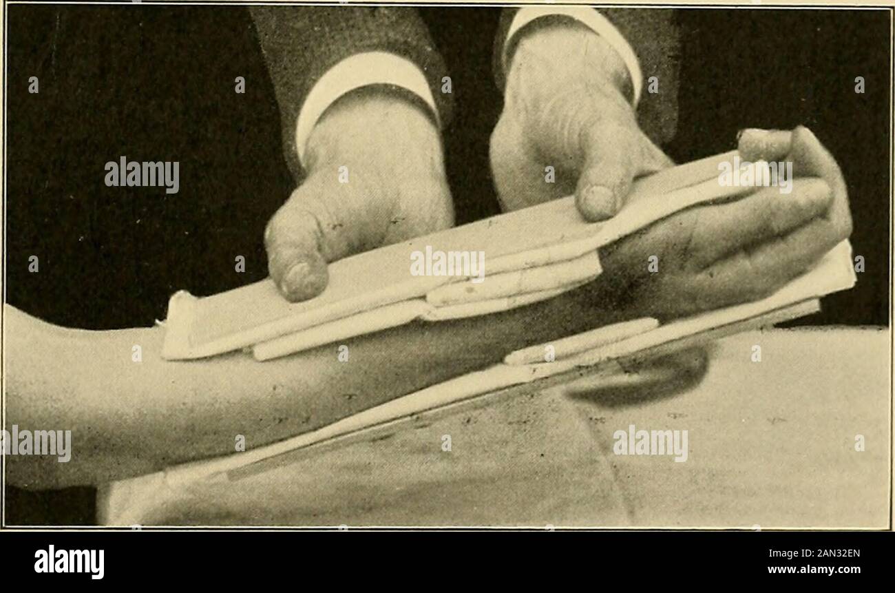 The treatment of fractures . 310.—Fracture of radius near wrist. Method ...