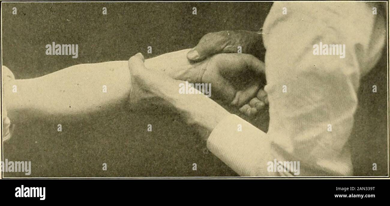 The treatment of fractures . Fig. 307.—Reduction of Colles fracture ...